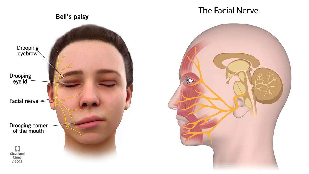 فلج بلز و درمان فلج بلز به همراه 10 تمرین - دکتر مهسا موسوی