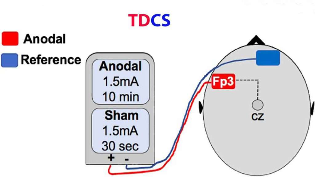 تحریک الکتریکی مغز Tdcs چیست؟کاربرد تحریک الکتریکی مغز 1403