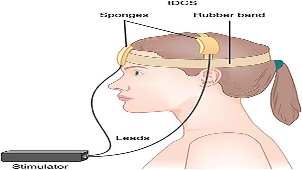 تحریک الکتریکی مغز (TDCS)چیست؟کاربرد تحریک الکتریکی مغز 1403
