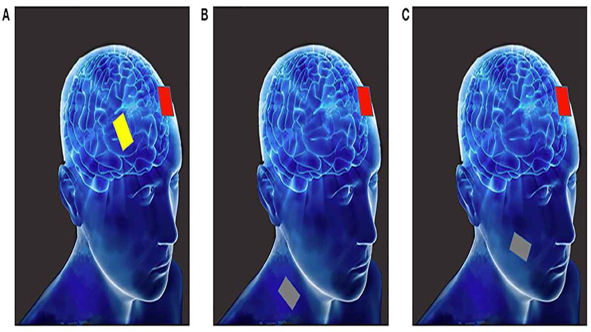 تحریک الکتریکی مغز Tdcs چیست؟کاربرد تحریک الکتریکی مغز 1403