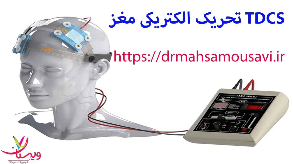 تحریک الکتریکی مغز (TDCS)چیست؟کاربرد تحریک الکتریکی مغز 1403